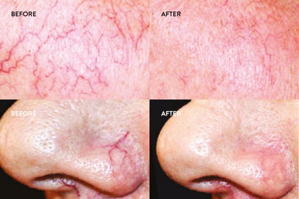 Thread Vein Removal (Face & Leg) – A Vita